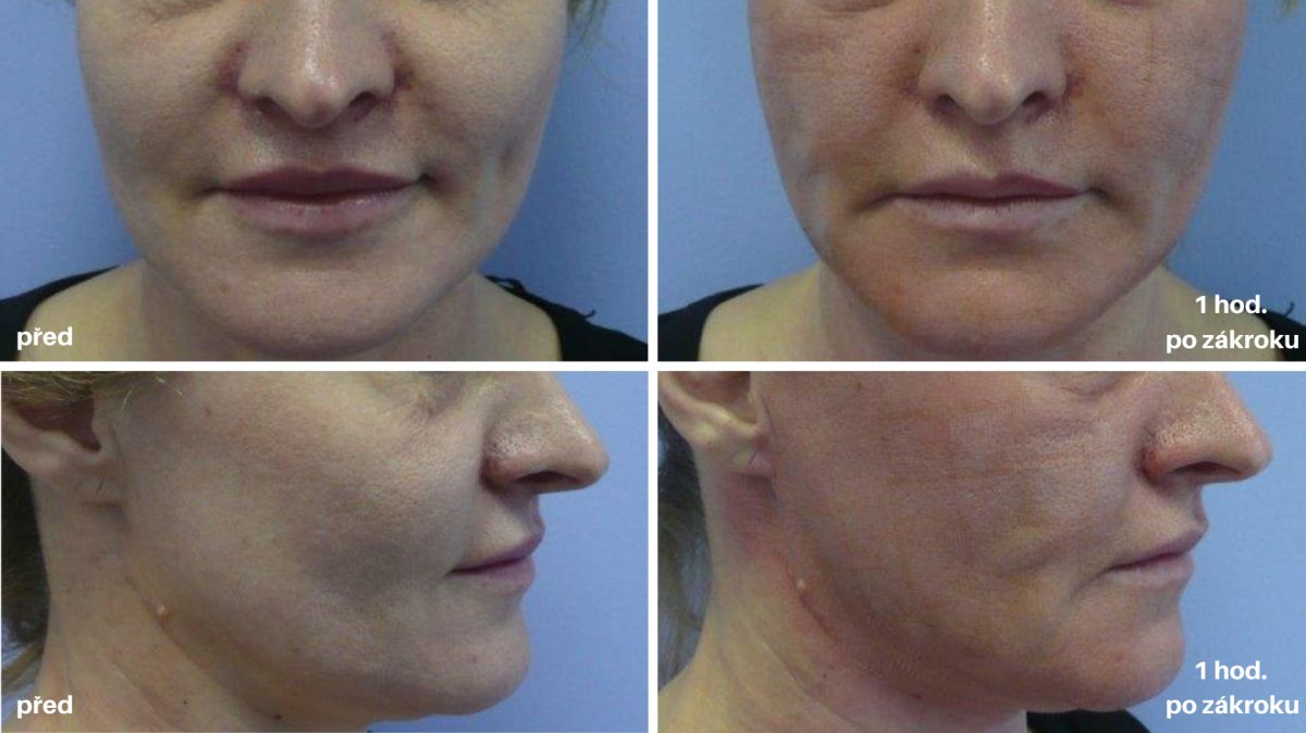 Frakční CO2 Laser | Frakční CO2 laser | UEM